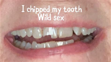 I Had Wild Sex And Chipped My Tooth Youtube