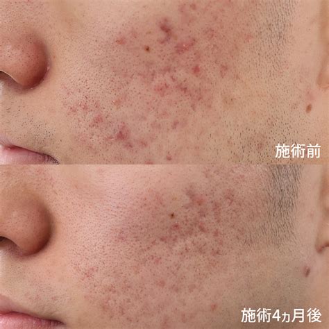 自身の血液でニキビ痕を改善！自然治癒力を促す【赤ヴァンパイアフェイシャル】｜症例写真・ビフォーアフター｜美容整形･美容外科のtaクリニックグループ
