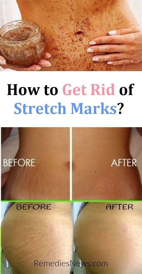 How To Permanently Get Rid Of Stretch Marks In 2020 Stretch Mark