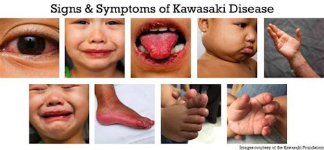 Kawasaki Disease Clinical Guidelines