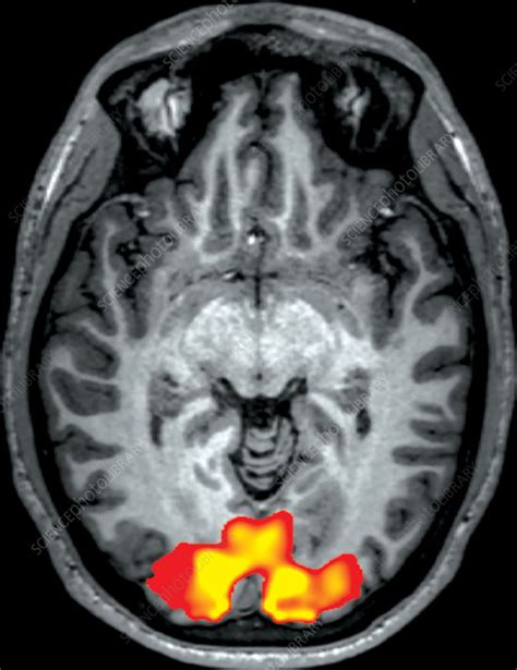 Fmri During Visual Stimulation Stock Image C030 6408 Science