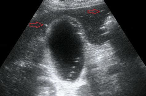 Acute Emphysematous Cholecystitis With Secondary Portal