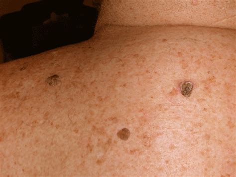 Symptoms And Causes Of Seborrheic Keratosis You Should Know About