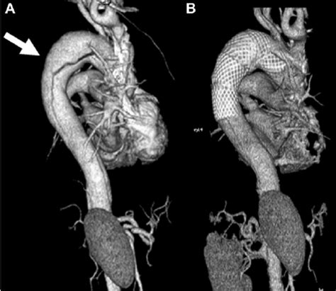 Aortic Dissection Ct Scan