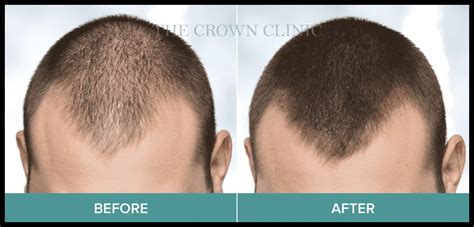 Hair Loss Medications And Treatments Crown Clinic