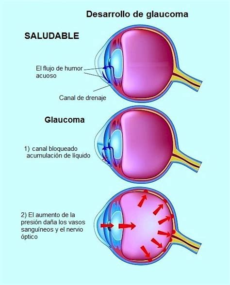 Glaucoma Ocular Síntomas Agudo Ojos Operacion
