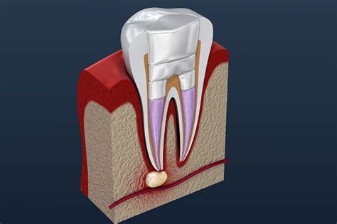 牙科填充程式 diagramm3d 插圖 照片檔及更多 根管 照片 istock