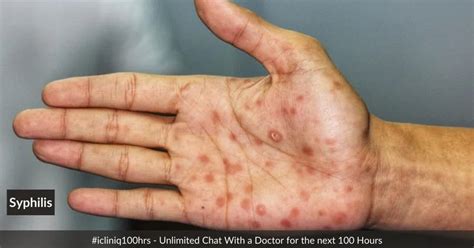 Syphilis Symptoms Risk Factors Treatments Prevention