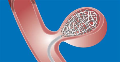 Coil Embolization For Brain Aneurysm Atlanta Ga Spine Surgery
