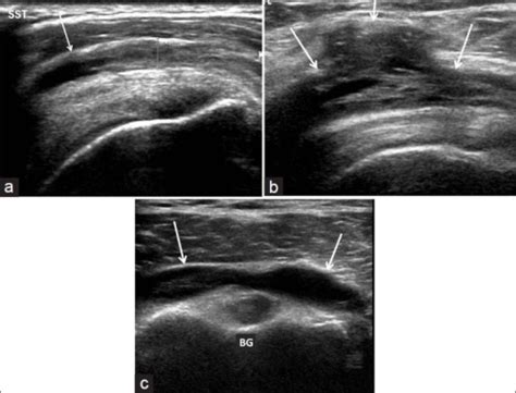 Subacromial Bursal Injection