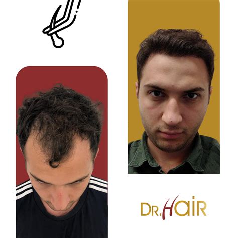 Do Turkey Hair Transplants Work Clinicpark