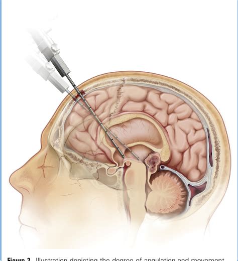 Figure 2 From Endoscopic Third Ventriculostomy Outcome Analysis Of An