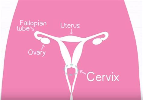 [diagram] Iud Cervix Diagram Mydiagram Online