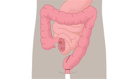 Surgical Animations