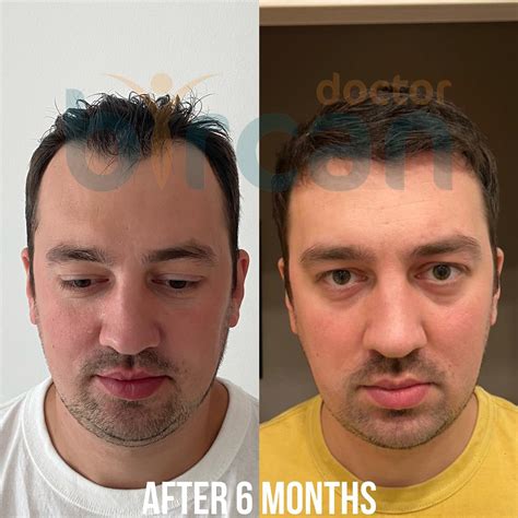 The Best Hair Transplant Surgeon Dr Sait Gökhan Bircan