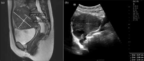 A Magnetic Resonance Imaging Showing An Extensive Adenomyosis At The