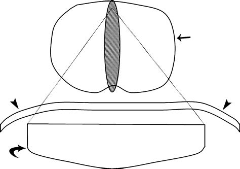 Transrectal High Intensity Focused Ultrasound Ablation Of Prostate