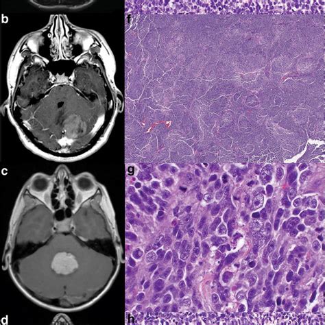 Of Medulloblastoma Subgroups Adapted From Cavalli Et Al Intertumoral