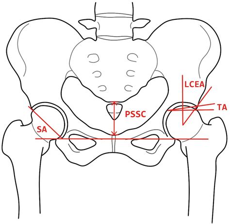 Anteroposterior Ap Pelvic Radiograph In Standing Position Is Shown