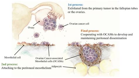 Cancers Free Full Text Ovarian Cancer Associated Mesothelial Cells