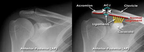 Acromioclavicular X Ray