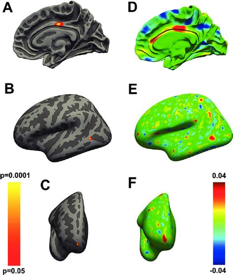 a vertex wise statistical map showing the positive association