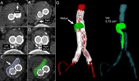 Ct Features Of Early Type Ii Endoleaks After Endovascular Repair Of
