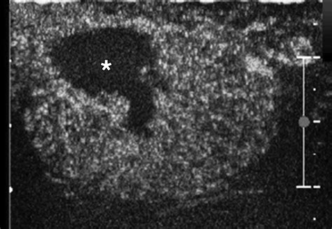 Acute Segmental Testicular Infarction At Contrast Enhanced Ultrasound