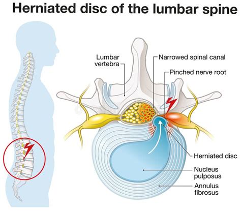 Herniated Disc Of The Lumbar Spine Stenosis Slipped Disc Labeled