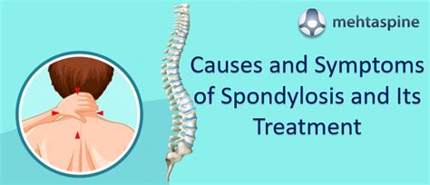 Causes And Symptoms Of Spondylosis And Its Treatment Mehtaspine Uk