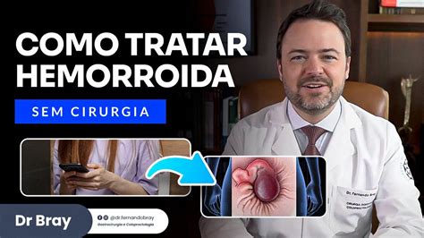 Como Tratar Hemorroida Sem Cirurgia Youtube