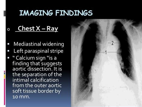 Aortic Dissection Aortic Dissection Dissection Thorax
