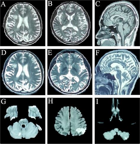 Frontiers Case Report A Novel Mutation In Wfs1 Gene C 1756g A P