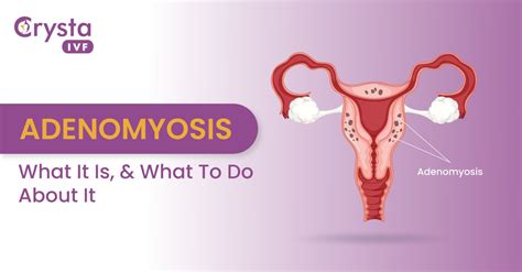Adenomyosis Meaning Symptoms Causes And Treatment