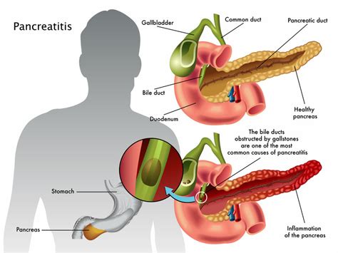 Pancreatitis Guide Causes Symptoms And Treatment Options