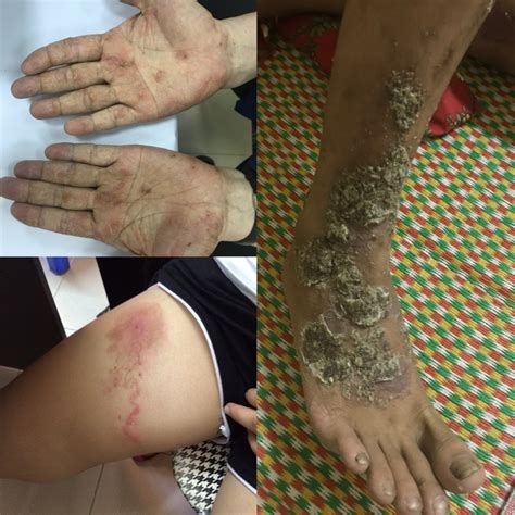 Ngứa Do Nhiễm Ký Sinh Trùng Từ Thú Cưng Nhiều Người Lầm Tưởng Là Bệnh