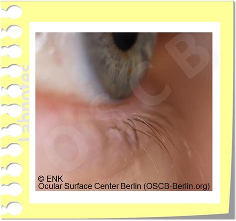 Glimpse On The Lid Margin — Ocular Surface Center Berlin