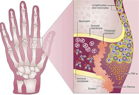 T Cell Mediated Autoimmune Diseases Immunopaedia
