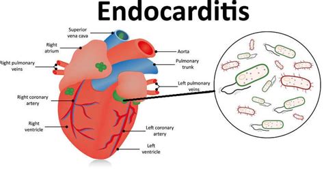 Infective Endocarditis Causes Symptoms Diagnosis Treatment And