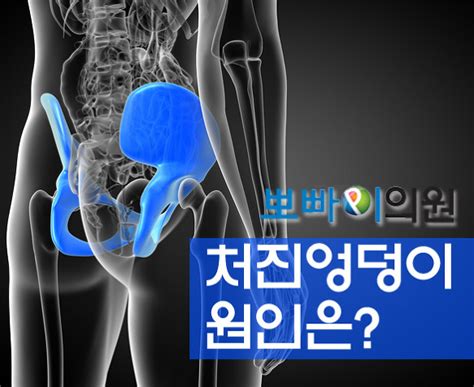 [인천골반교정] 처진엉덩이 원인으로 골반후방경사 의심