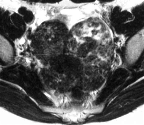 Ct And Mri Findings Of Sex Cord Stromal Tumor Of The Ovary Ajr