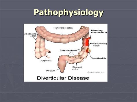 Diverticulitis