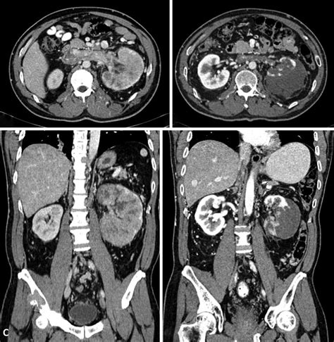 Contrast Enhanced Computed Tomography Abdomen Before A And C And 1