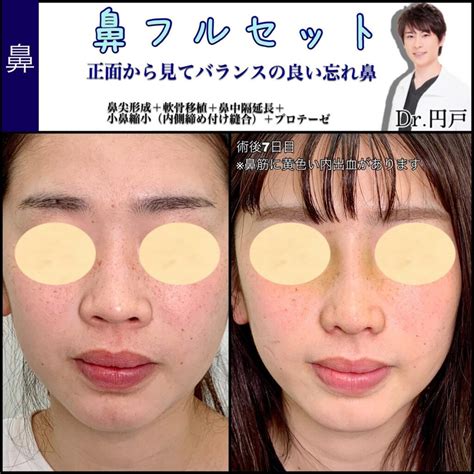 鼻プロテーゼの名医の見つけ方を医師が解説｜金沢の美容整形外科なら Eクリニック
