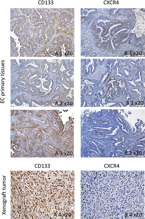 Immunohistochemistry Of Cd133 Cxcr4 In Tumor Tissue Which From The