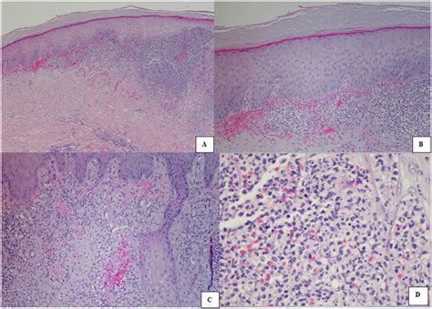 Neutrophilic Dermatosis In Myelodysplastic Syndrome And Chronic Active