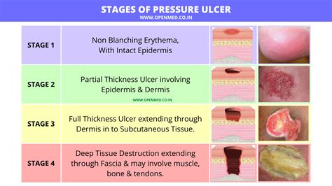 Pressure Ulcer Stage 1