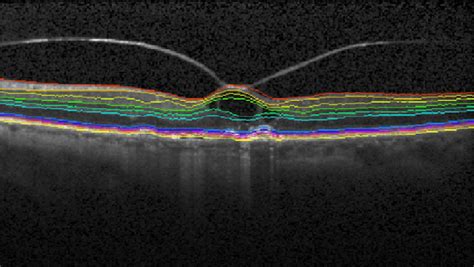 Oct Image Of Retina To Visualize The Order And Position Of The