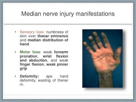 Peripheral Nerve Injuries