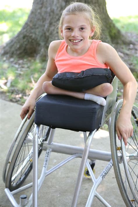 Sacral Agenesis Caudal Regression Syndrome Positive Exposure